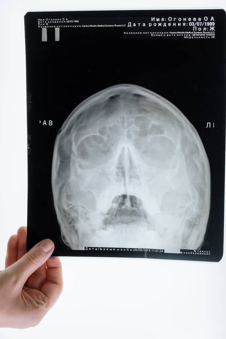 World Radiography Day repeated x-ray can cause cancer in body unknown ...