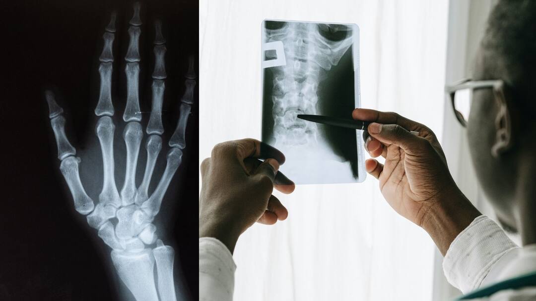 World Radiography Day repeated x-ray can cause cancer in body unknown ...