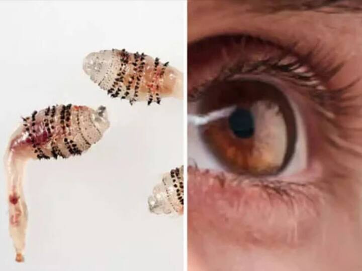 Man's 'itchy eye' turns out to be a dozen squirming fly larvae around ...