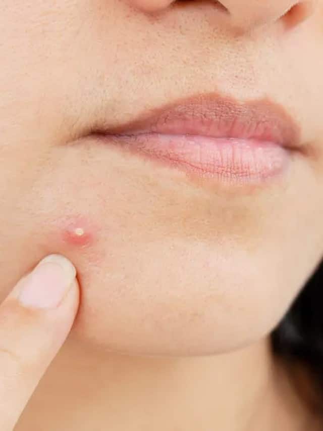 tips to get rid of pimples easily
