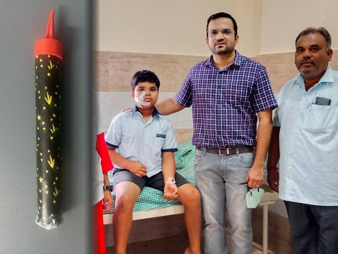 Chandrapur news Birthday sparkler candles explode a 10 year old boy ...