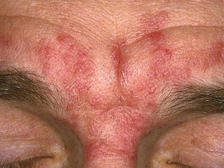 Scabies is an itchy skin rash caused by a tiny burrowing mite | Scabies ...