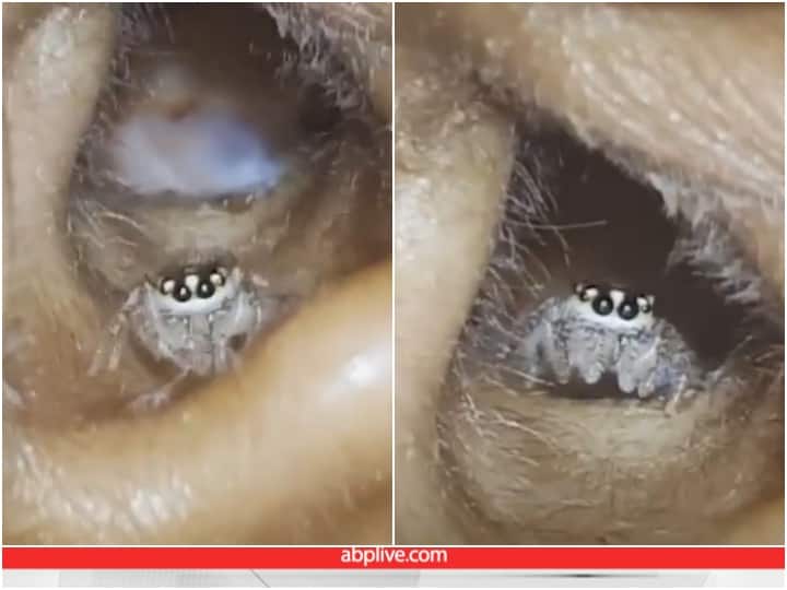 spider inside ear in woman video goes viral on social media | Video ...