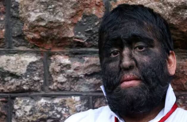 hypertrichosis-mp-boy-lalit-patidar-diagnosed-with-excess-body-hair ...