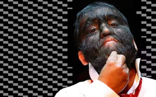 hypertrichosis-mp-boy-lalit-patidar-diagnosed-with-excess-body-hair ...
