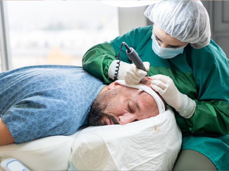 Debunking Hair Transplant Myths See What Experts Say
