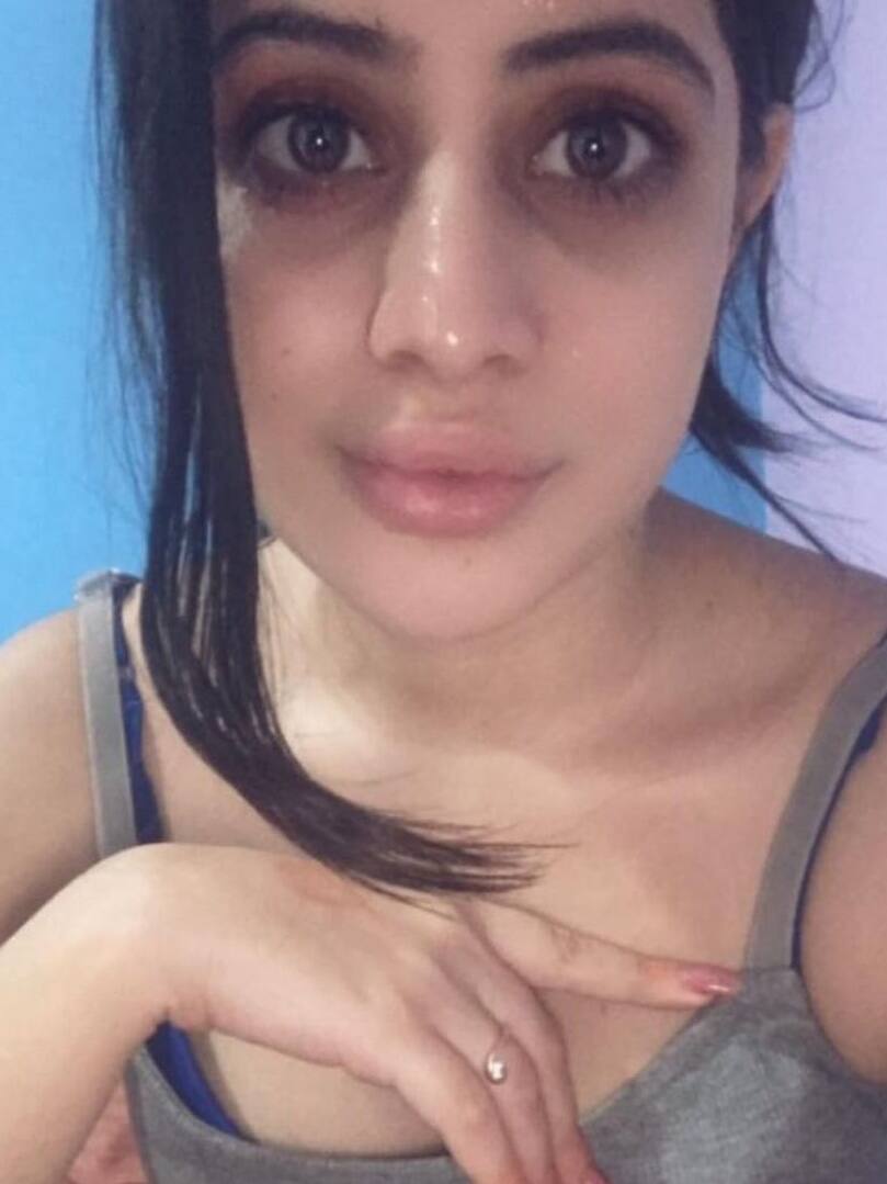 लिप फिलर से बिगड़े चेहरे के बाद Uorfi Javed का छलका दर्द