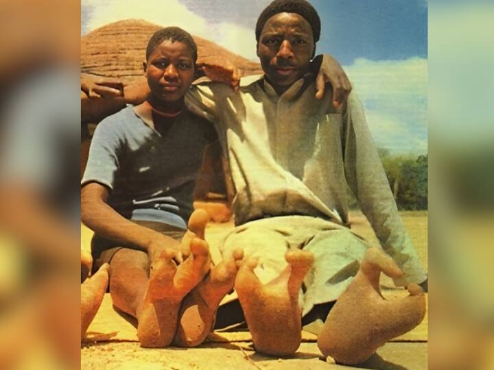 Ostrich Foot Syndrome Zimbabwe Vadoma People Famous For Ectrodactyly ...