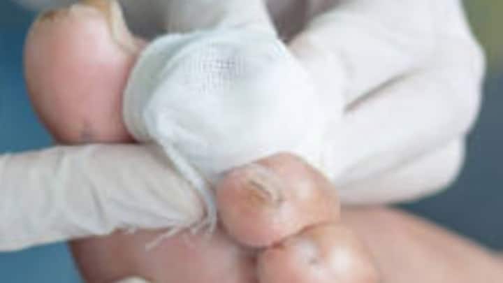 Know the symptom of Diabetic Foot, in pics | Diabetes : ডায়াবেটিস হলে ...