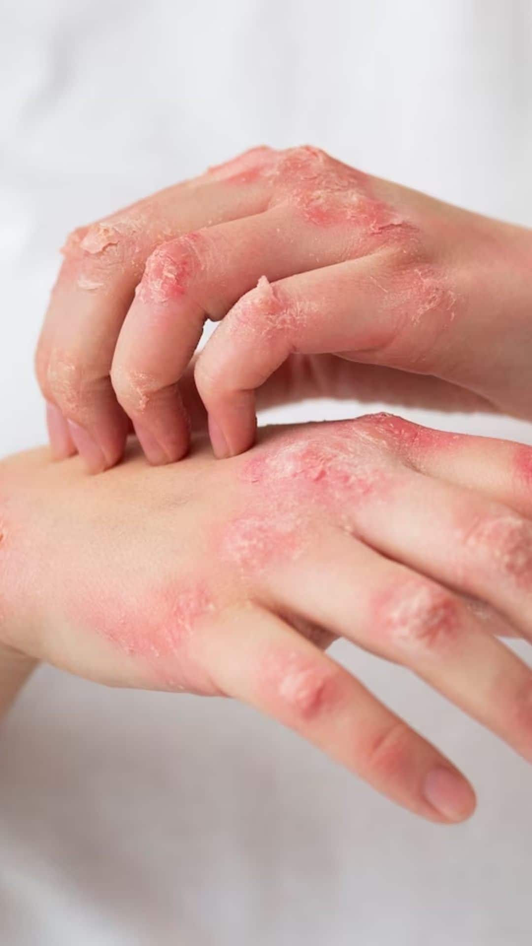 चर्म रोग होने के क्या कारण हैं, चर्म रोग की दवा क्या है?