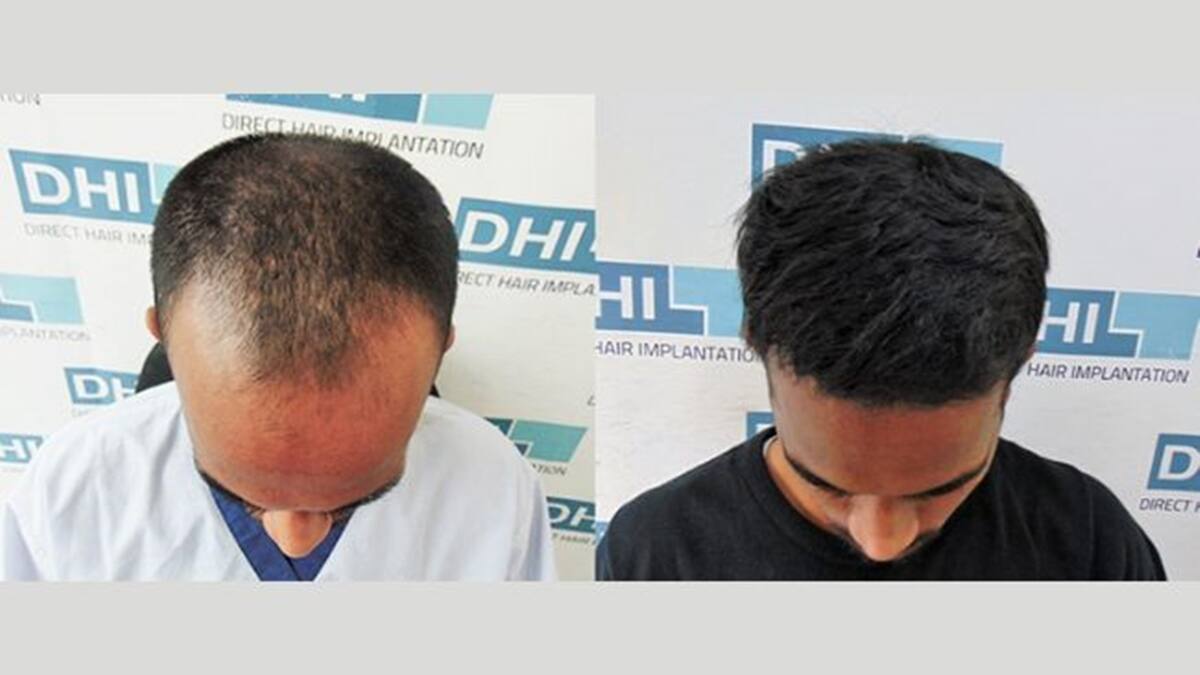 Exclusive Technique Now Available Only In DHI's Authorised Clinics ...