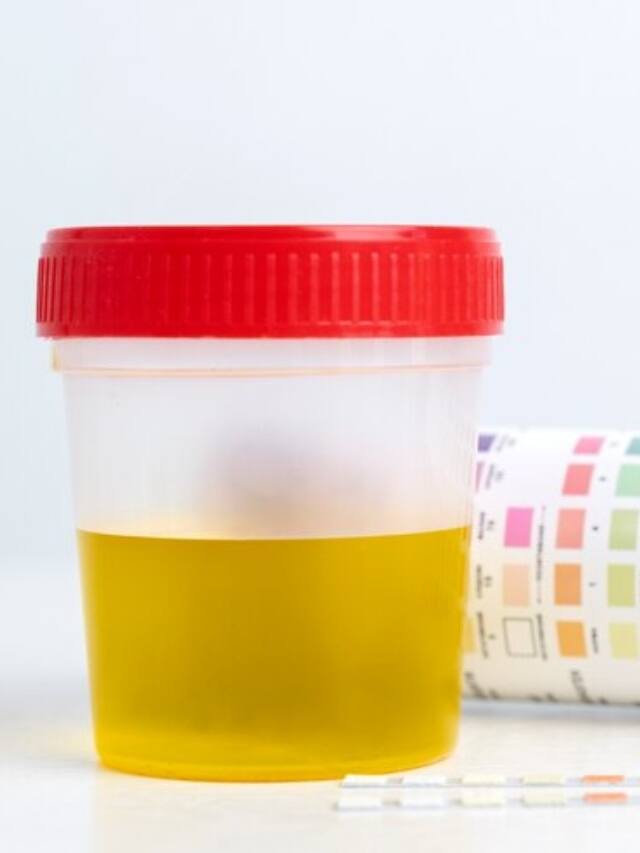 यूरिन के ये लक्षण हैं हाई यूरिक एसिड का संकेत, ऐसे करें पहचान