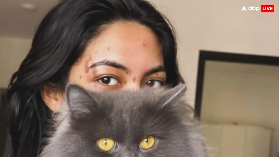 Reem Shaikh met with unfortunate incident shares pics scarred face ...