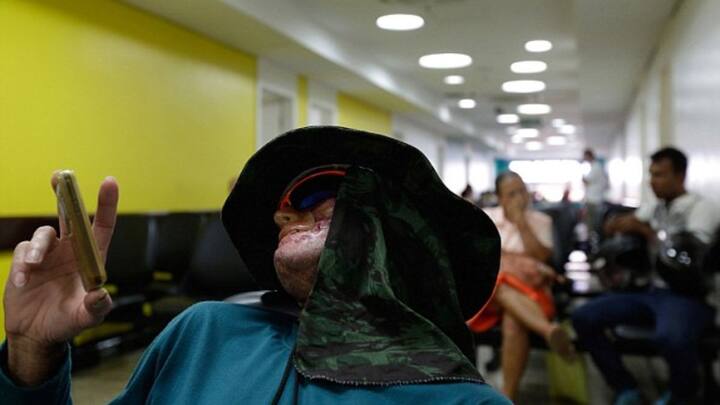 Rare skin disease in people of brazil villagers starts melting in ...