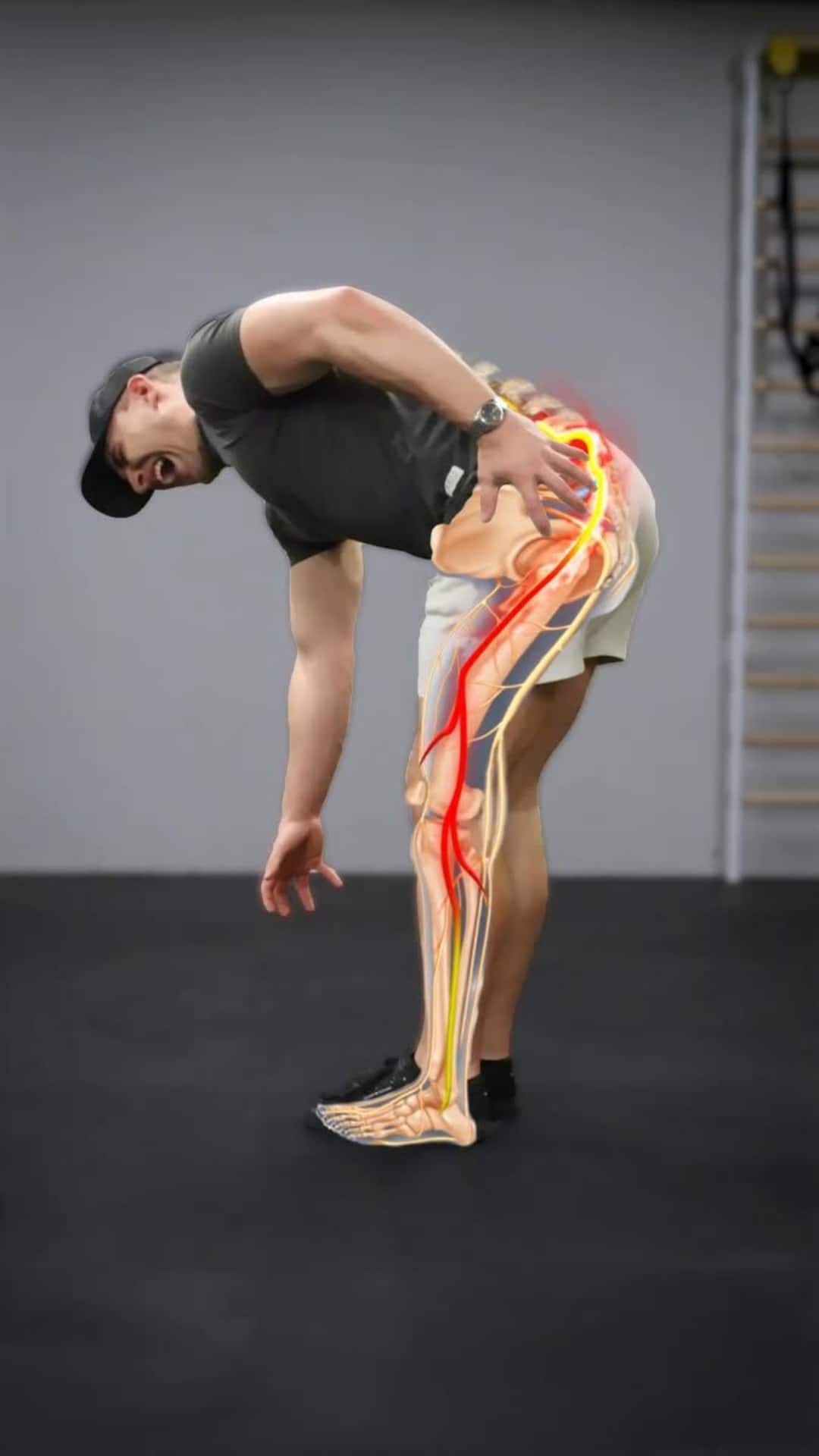 What Happens In Sciatica? 4 Key Symptoms That Reveal Serious Nerve Trouble