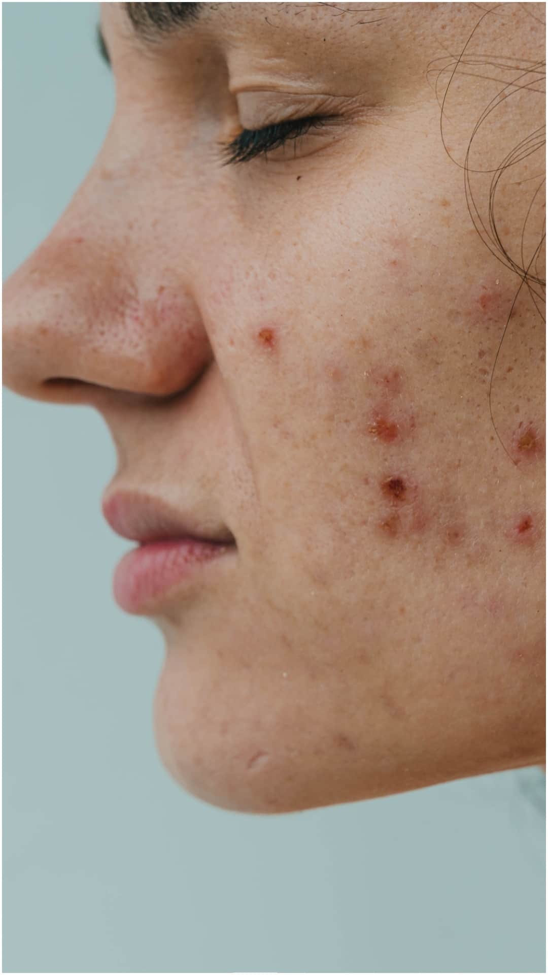 ਚਿਹਰੇ ‘ਤੇ ਵਾਰ-ਵਾਰ ਕਿਉਂ ਹੁੰਦੇ Pimples?