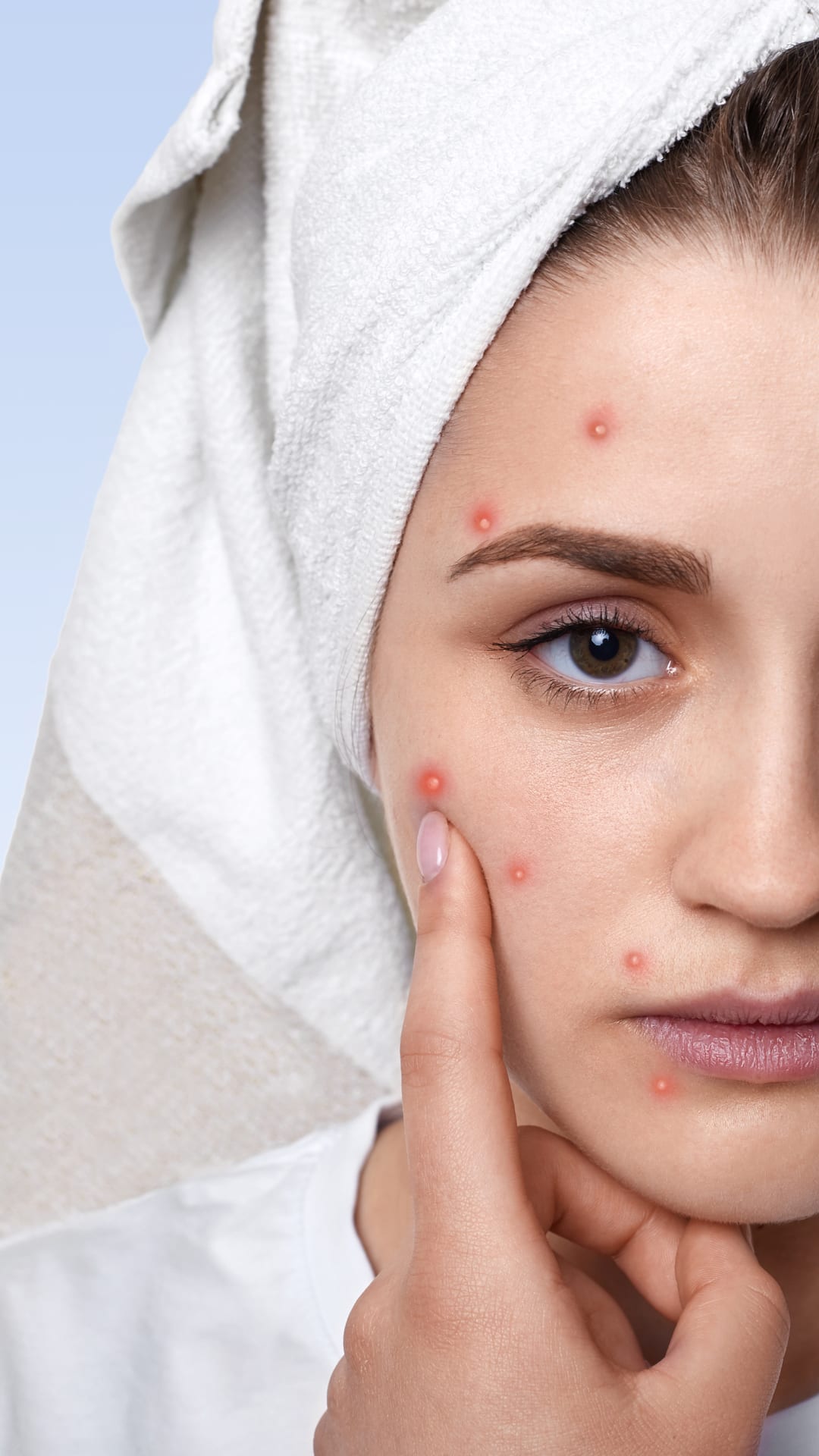Pimples Keep Returning? Here Are The Most Common Causes Behind It